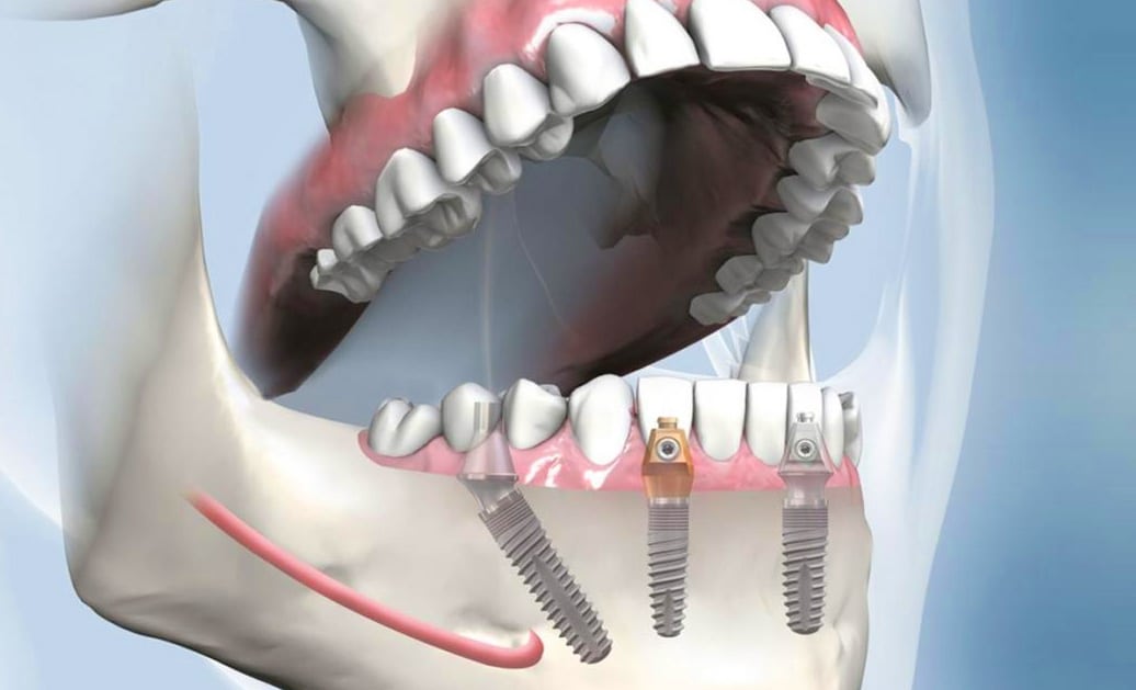 Dinti Ficsi in 24 ore - Implant dentar rapid , o dantura fixa intr-o zi