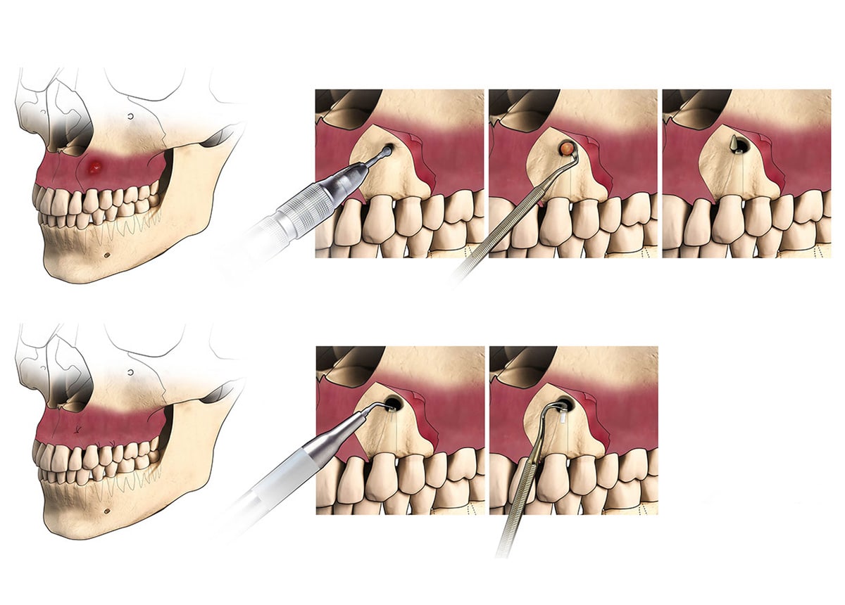 Rezectie apicala - Agident