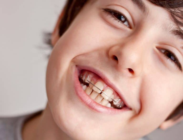 Aparat Dentar pentru copii si adulti preturi